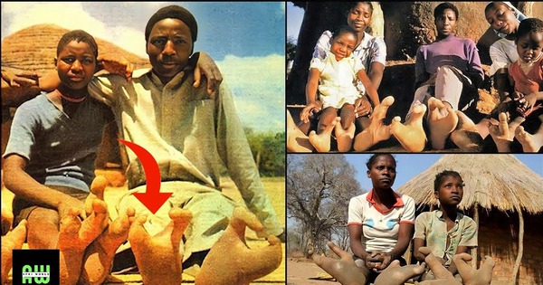 Bí ẩn về bộ tộc "đà điểu": Không thể đi giày vì thiếu ngón chân!